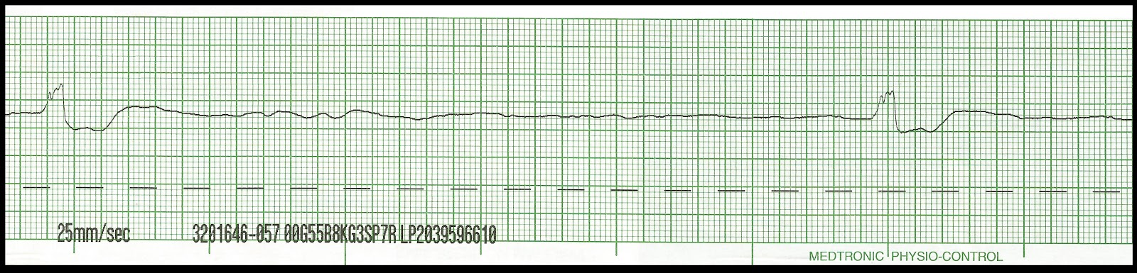 EKG Rhythm Strips 91 Various Agonal Rhythms