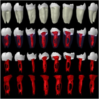 BLOG DE LA CATEDRA DE ENDODONCIA USAL/AOA: SEGUNDO MOLAR INFERIOR EN “C ...