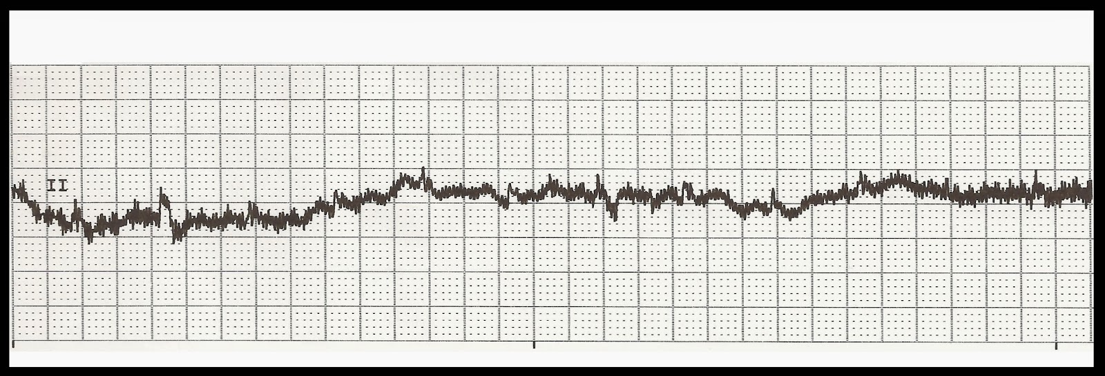 EKG Rhythm Strip Quiz 185