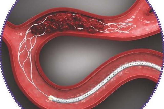 Device That Grabs Blood Clots Could Help Treat Stroke Cases | WFLScience