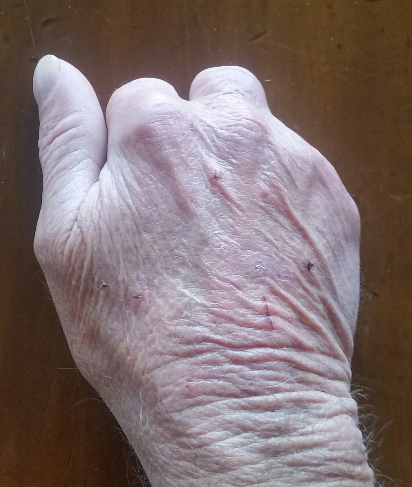 Velo Vortmax Finger Frostbite Amputation Photographs