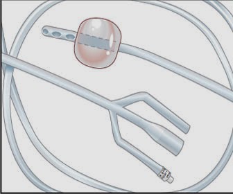 Continuous Bladder/Catheter Irrigation ~ Nursing