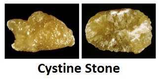 Kidney Stone: Symptoms, Causes, Treatment, and its homeopathic ...