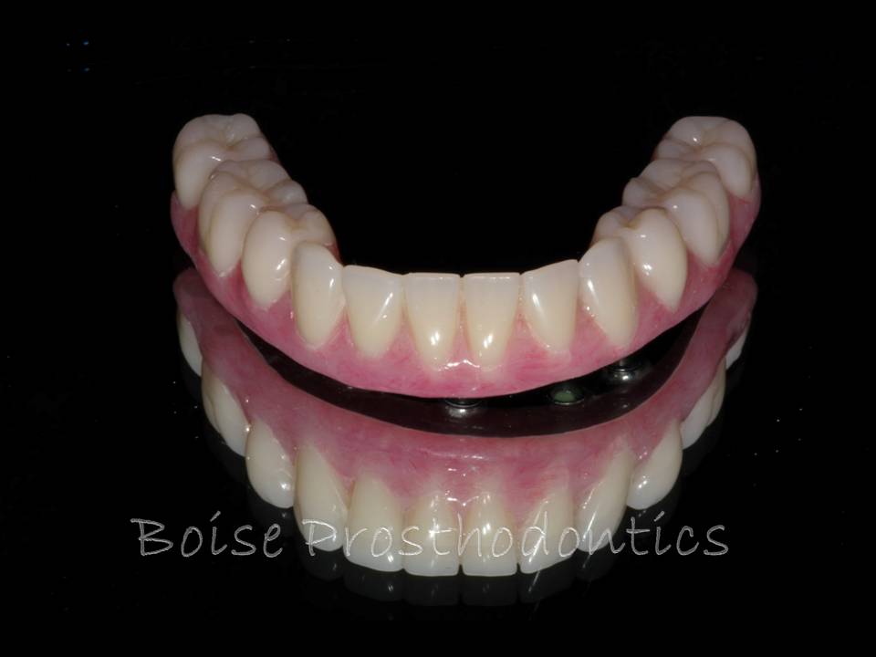 Boise Idaho Prosthodontics: Picture Sequence of Maxillary Complete ...