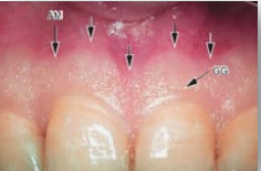 UNIDAD III: Encía Periodontológica