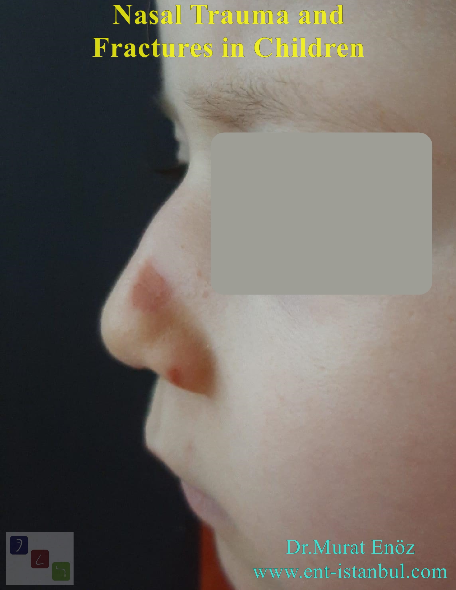 Nasal Fractures - Causes, Symptoms, Diagnosis, Treatment