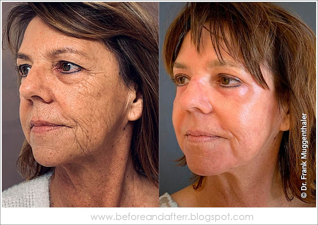 Phenol Peeling Before After Pictures Real Before And After
