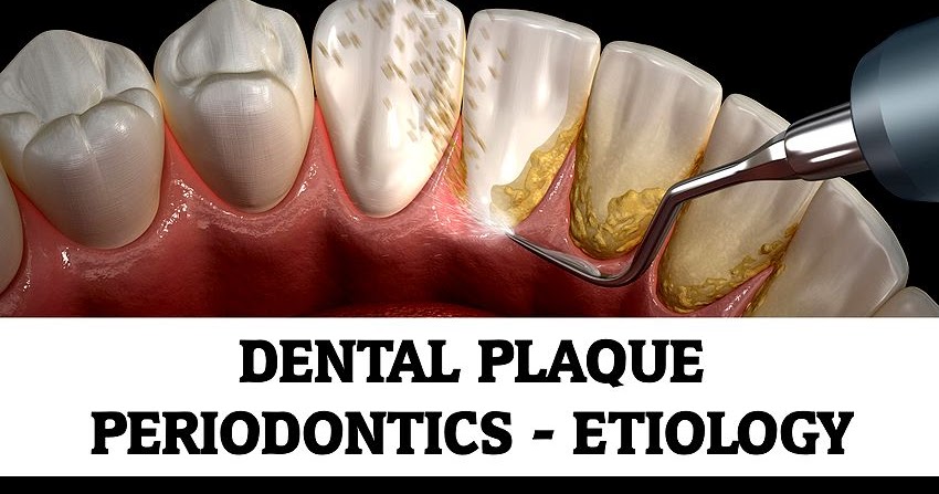 DENTAL PLAQUE: Composition and Etiology - Mental Dental - Odonto-Tv