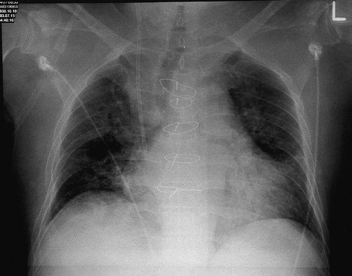 Can Chest X Ray Detect Heart Failure at Margaret Aguirre blog