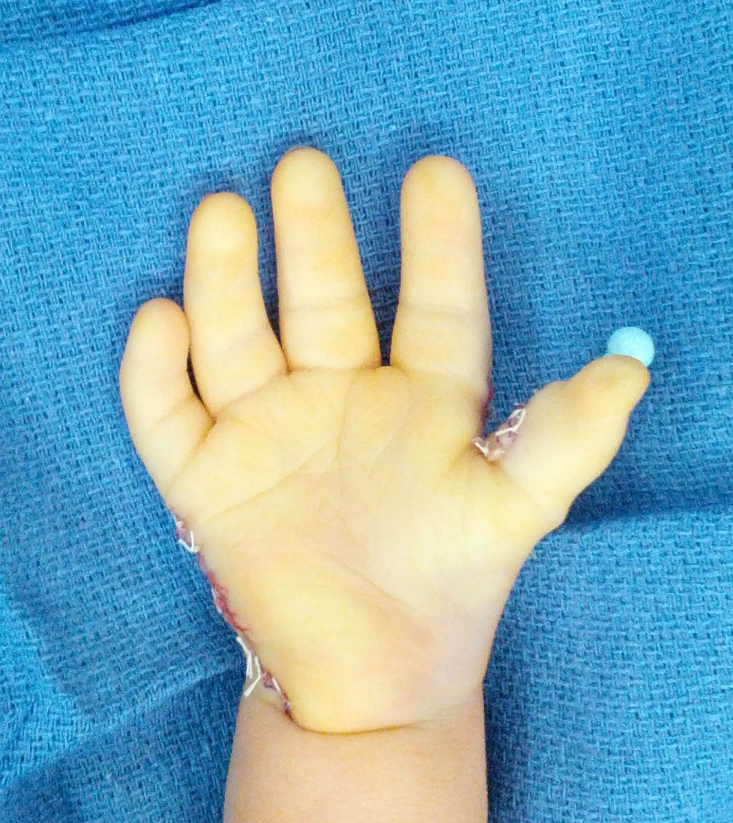 Congenital Hand and Arm Differences