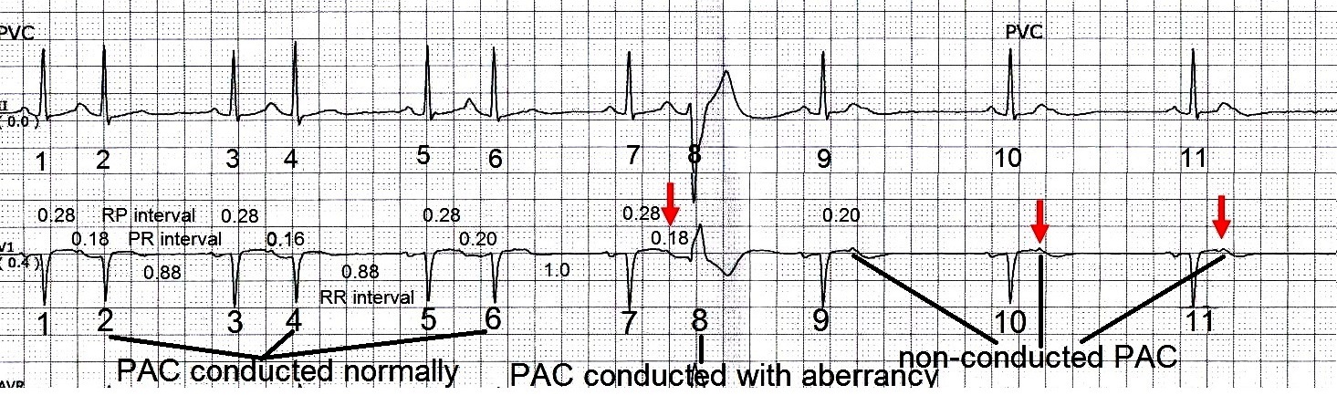 ECG Channel: Premature Atrial Complexes