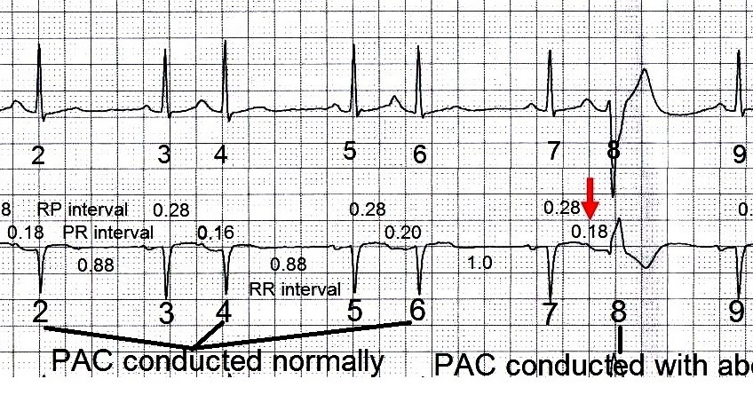 ECG Channel: Premature Atrial Complexes