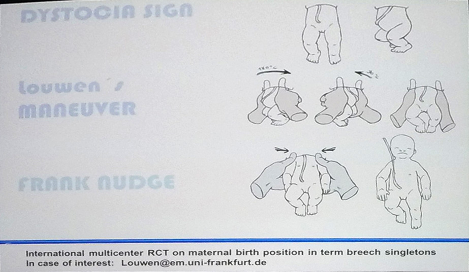 Stand and Deliver: Anke Reitter: New Insights from Pelvimetric MRI ...