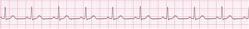 Dentistry and Medicine: ECG Rhythm Interpretation-How to Analyze a Rhythm