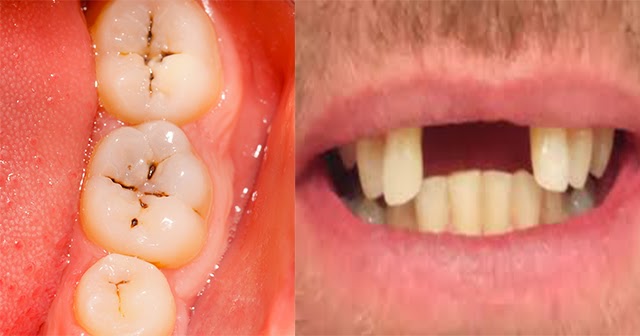 Ito ang 7 Uri ng Pagkain na Nakakasira ng ating mga Ngipin.