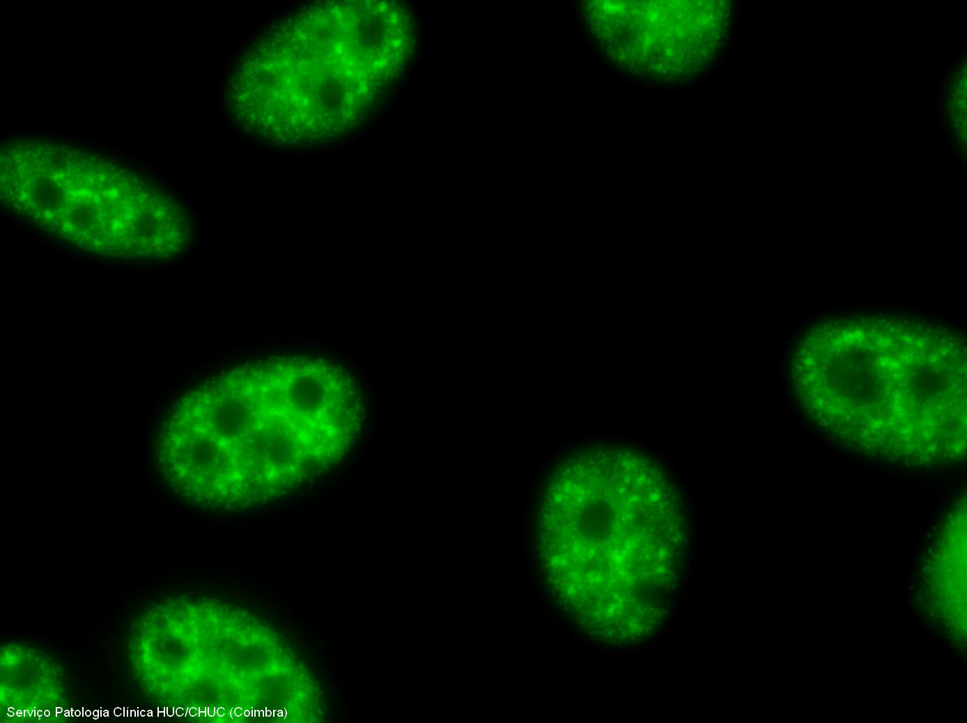 Anticorpos anti - Sm e anti - RNP