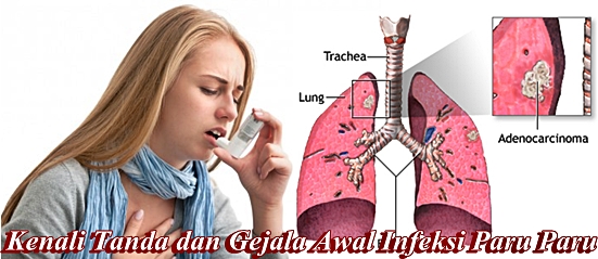 Kenali Tanda dan Gejala Awal Infeksi Paru Paru ~ Walatra Gamat Emas Kapsul