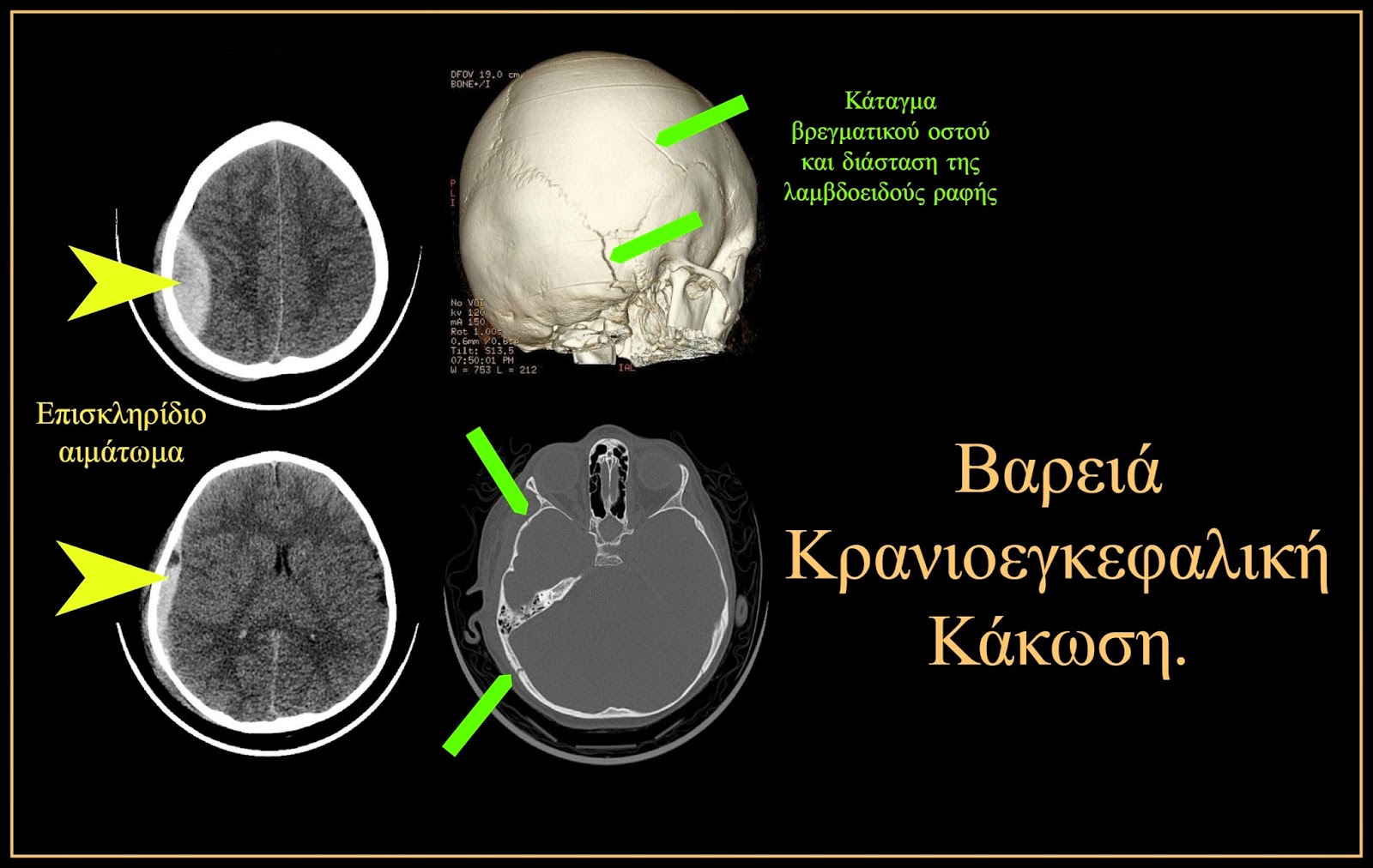 Κωνσταντίνος Χ. Δαβανέλος: Βαρειά κρανιοεγκεφαλική κάκωση.