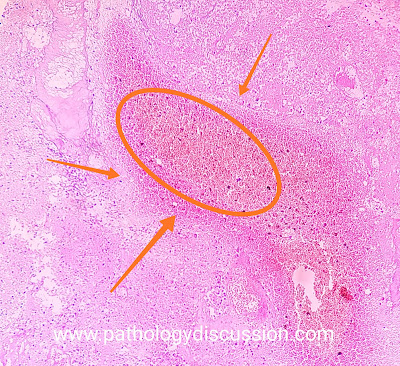 Pigments: Melanin,lipofuscin,hemosiderin,hemozion,bilirubin etc