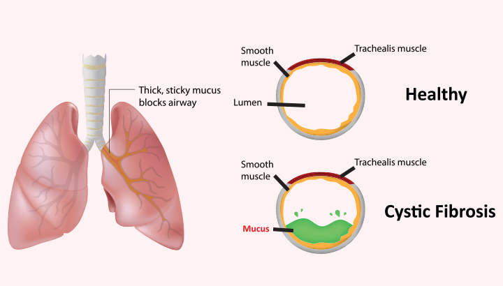 CYSTIC FIBROSIS: Introduction