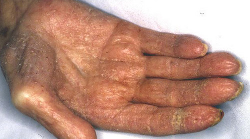 Scabies Rash Pictures | Medical Pictures and Images - (2023 Updated)