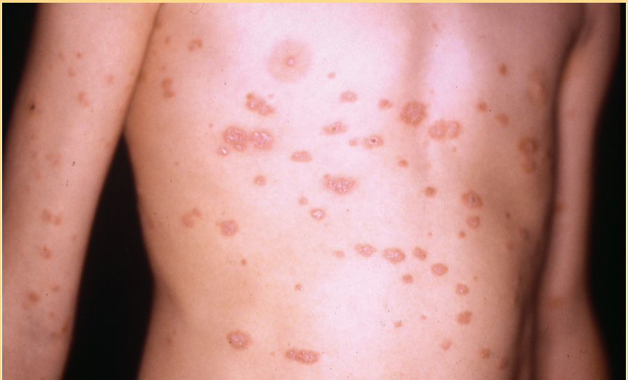 La Psoriasis | Medicusmeo