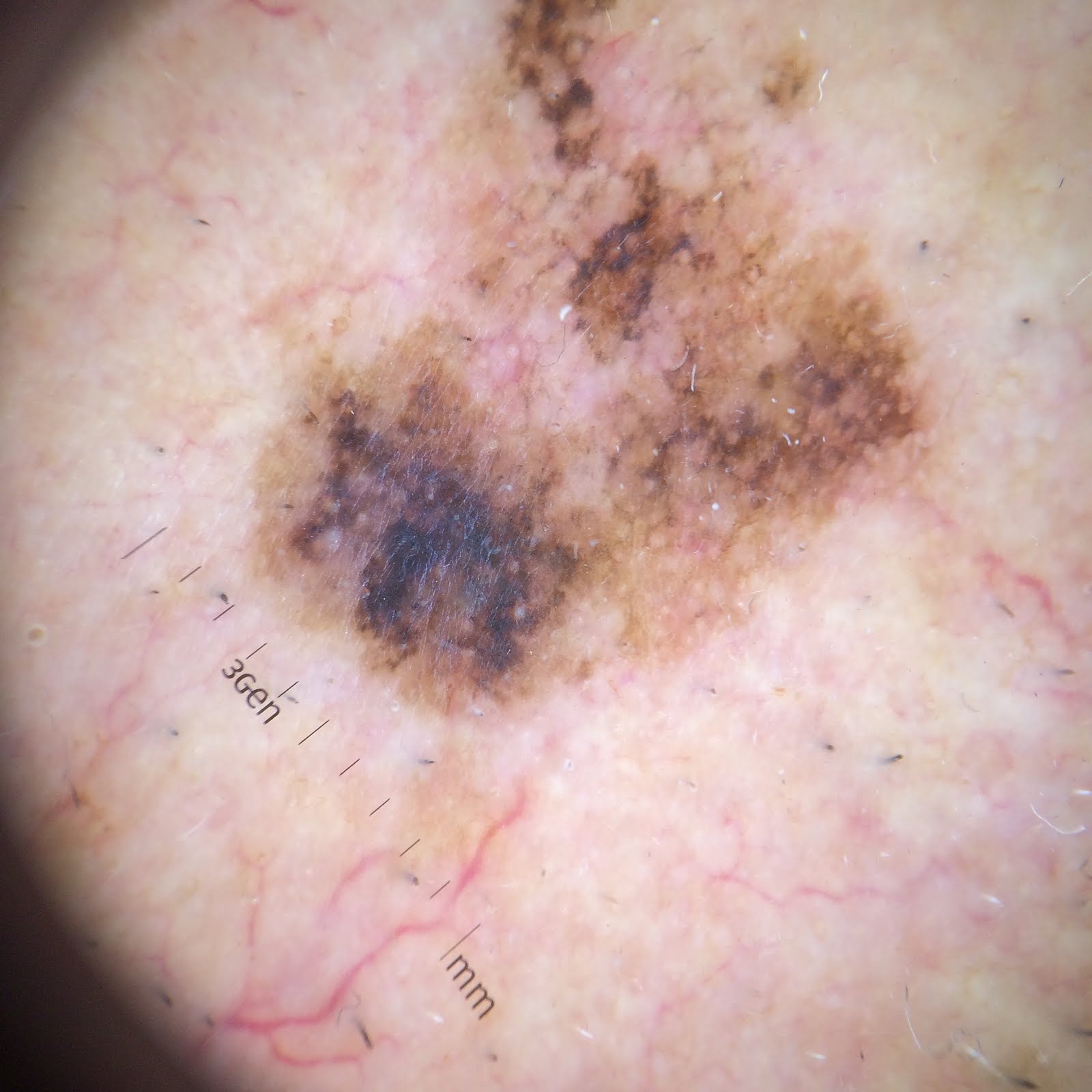 DERMATOLOGÍA TENERIFE. Dra. Nayra Merino: MANCHAS EN LA PIEL: SIEMPRE ...