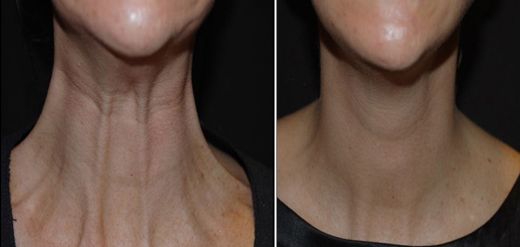 Expansion Of The Neck With Sunken Throat Exercises And Face Yoga: Plump ...