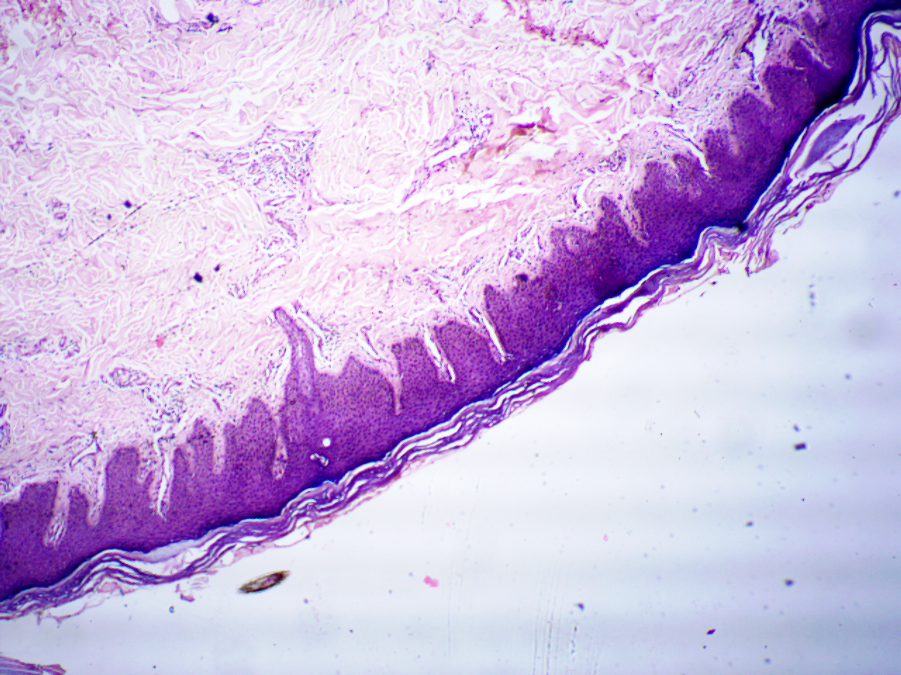 into the roots: Psoriasiform reaction pattern