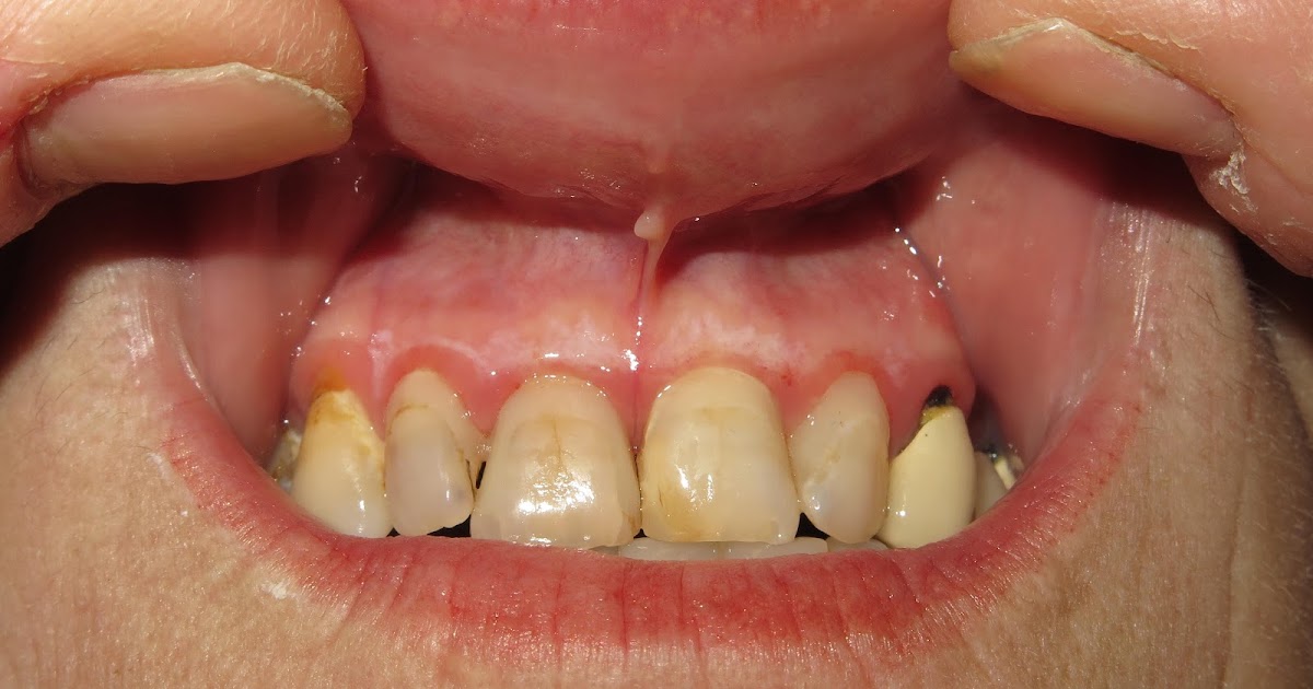 Dermapixel: Liquen escleroso oral: una localización infrecuente