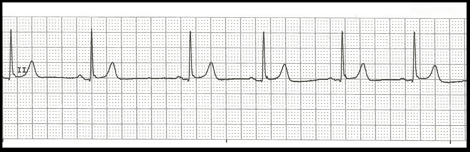 Practice EKG Rhythm Strips 155