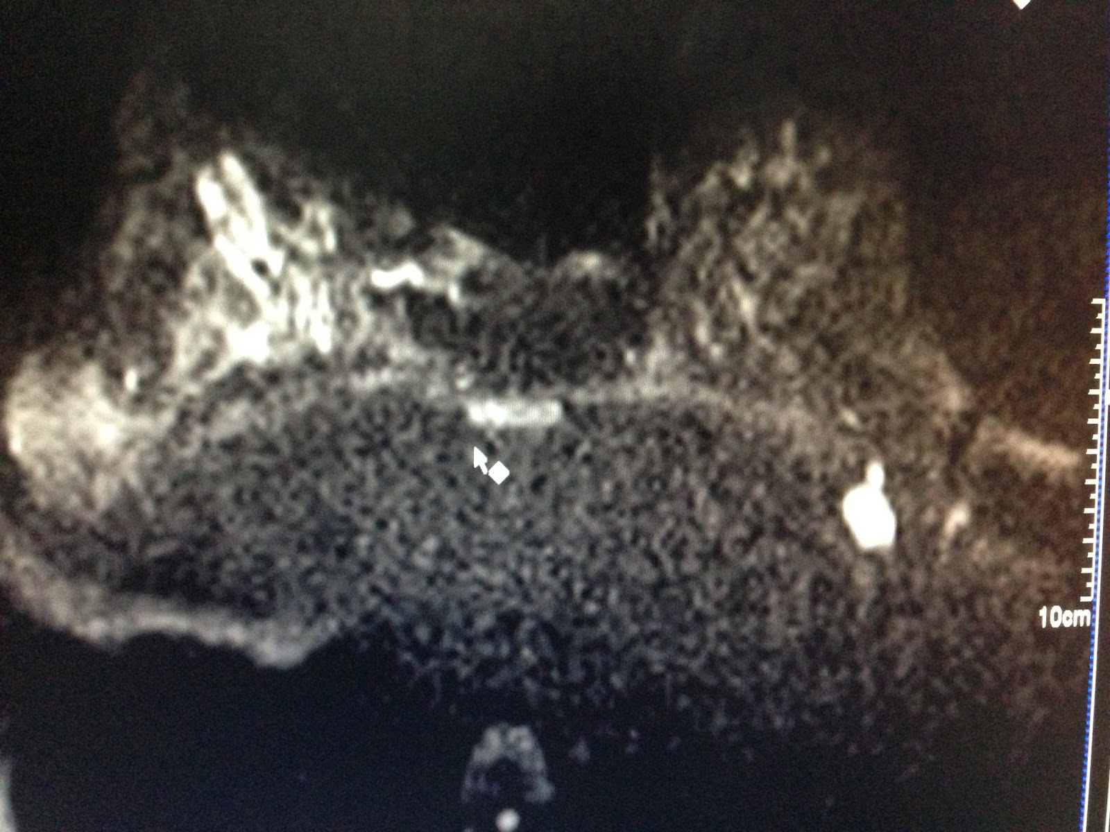 VIETNAMESE MEDIC ULTRASOUND: CASE 343: TB AXILLARY NODES, Dr PHAN THANH ...