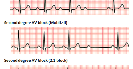房室傳導阻斷 AV block