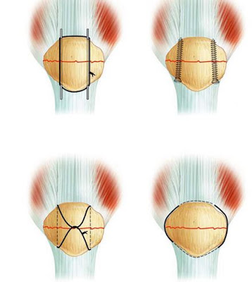 Un médecin du sport vous informe: fractures de la rotule