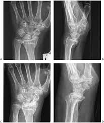 Medical Treatment Pictures-for Better Understanding: Arthroscopic Thumb ...