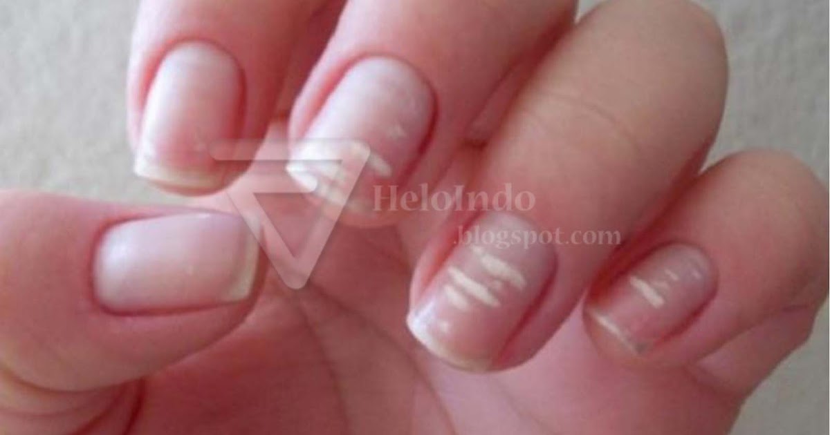 Ada Tanda Putih di Kuku Jari Tangan, Beginilah Penjelasannya | Helo Indo