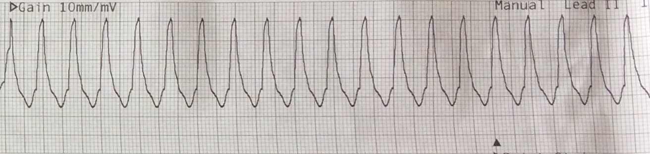 MedicEd makes it simple: Fast Rhythms_The Tachycardias