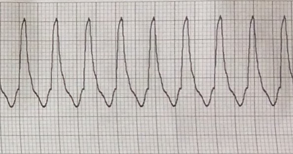 MedicEd makes it simple: Fast Rhythms_The Tachycardias