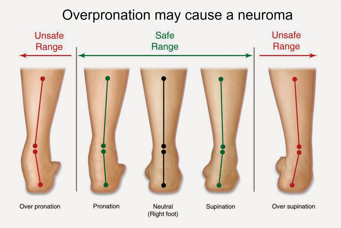 Issues Walking : r/walking