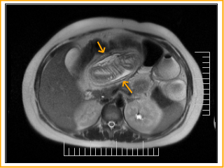 Small Bowel Intussusception Secondary to Polyp-MRI Diagnosis - Sumer's ...