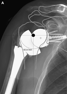 UW Shoulder and Elbow Academy: Reverse total shoulder - the issue of ...
