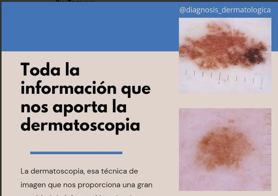BLOG DIAGNOSIS DERMATOLOGICA: La Dermatoscopia....