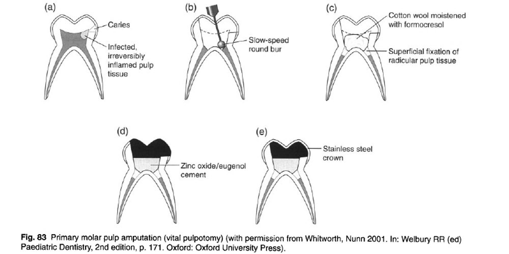 Chakra Project : A Journey To Future: File 08 - Perawatan Pulpa Dengan ...