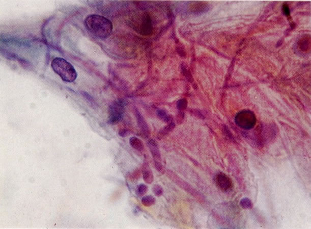Citomed Citologia: ESFREGAÇOS INFECCIOSOS - CANDIDA