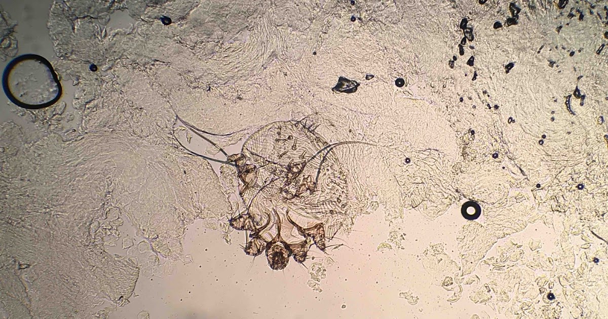 Dermapixel: Consejos para librarse de la sarna