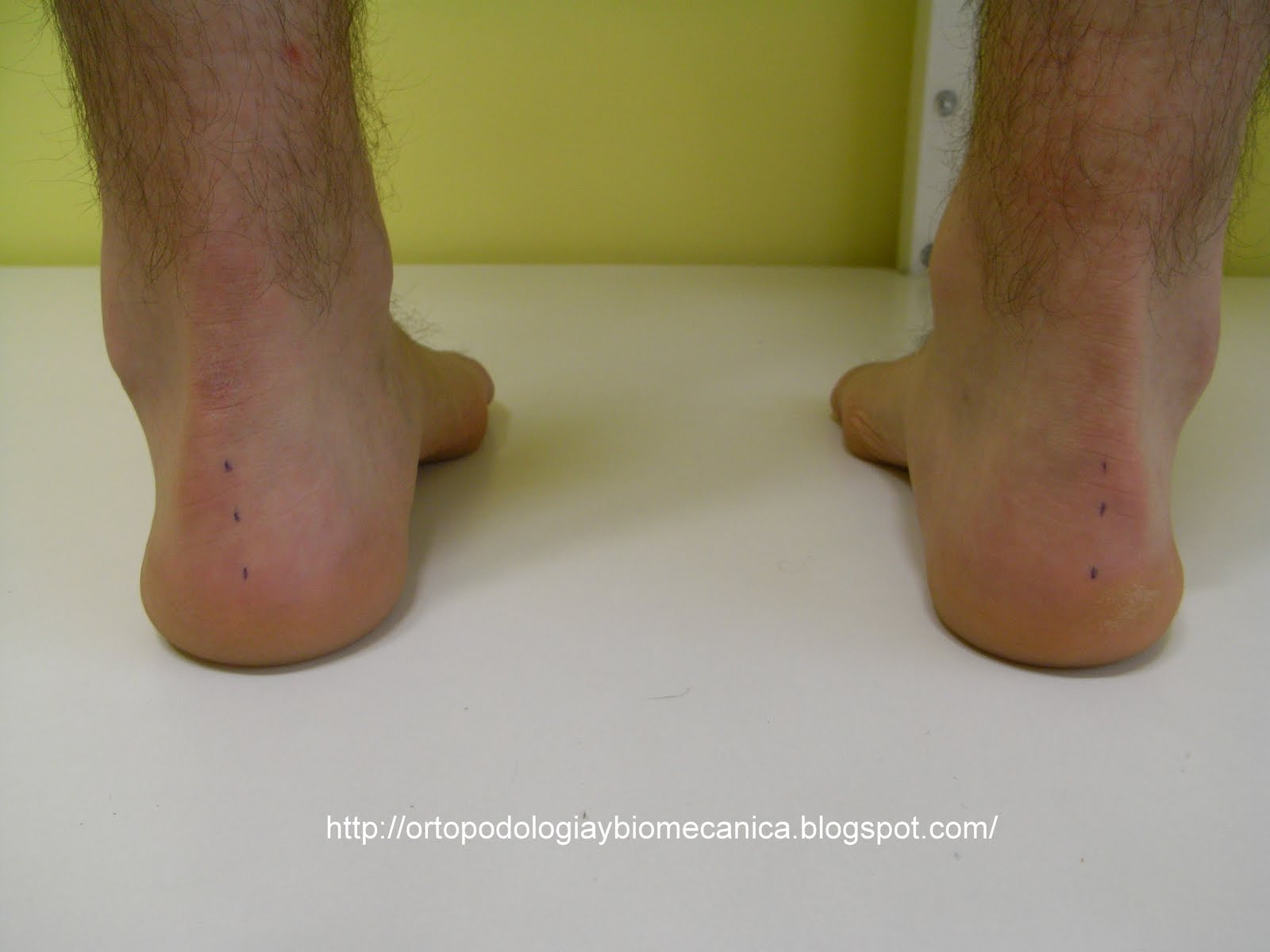 Ortopodologia y Biomecanica : “GAIT PLATE”. TRATAMIENTO METATARSO ADUCTO