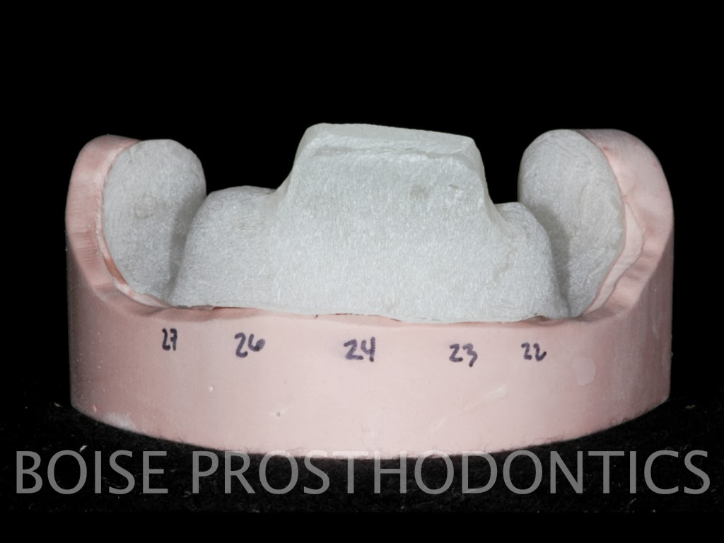Boise Idaho Prosthodontics: Intra-oral Luting of Implant Verification ...