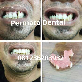 DOKTER GIGI BALI PERMATA DENTAL : JUAL GIGI PALSU MURAH | PERMANEN | LEPASAN | BONKAR PASANG ...