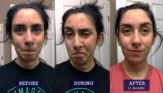 Prid vs Nexcare Acne Patches - Battle of the Holistic Spot Treatments ...