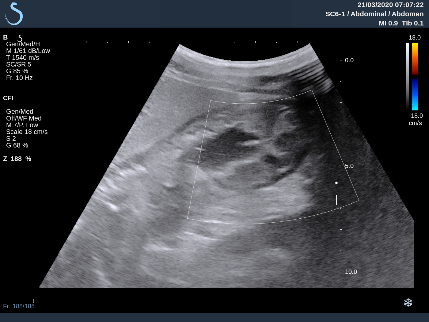 VIETNAMESE MEDIC ULTRASOUND: CASE 583: ANTRUM Linitis Plastica, Dr PHAN ...